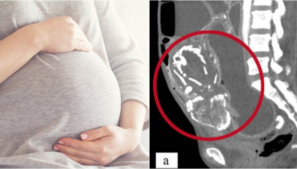Mujer muere por desnutrición tras alojar un feto momificado hace 9 años ...