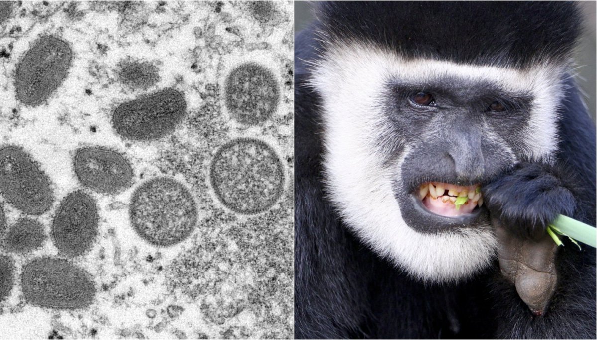 Primer caso humano de virus B está al borde de la muerte tras ataque de ...